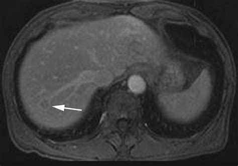 Hepatocellular Carcinoma With A Pseudocapsule On Gadolinium Enhanced Mr Images Correlation With