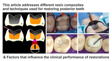 Dentist Composite Technique At Peggy Bradley Blog