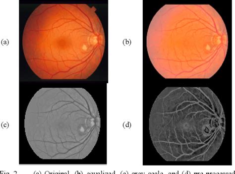 Figure 2 From A Machine Learning Based Approach For Segmenting Retinal Nerve Images Using