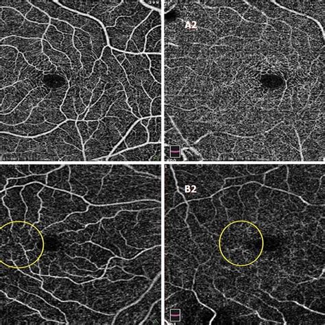 6 × 6 mm oct angiogram of a healthy control eye a1 superficial