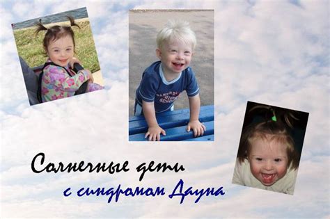Синдром Дауна болезнь Дауна даунизм трисомия 21 Солнечные дети Дети с синдромом Дауна