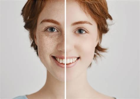 Hyperpigmentation Maple Clinic