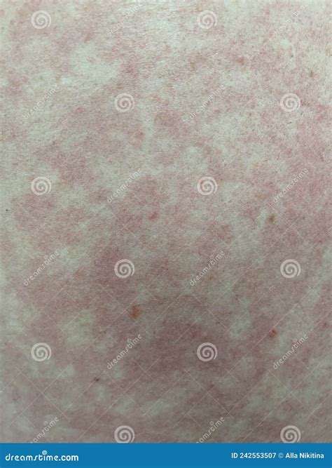 Close Up View Of Man Back Painful Back Skin Rash Stock Image Image Of Allergy Rash