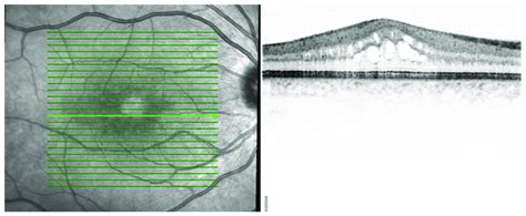 Oct Of The Right Eye Of A 28 Year Old Woman Showing Cme With Loss Of Download Scientific