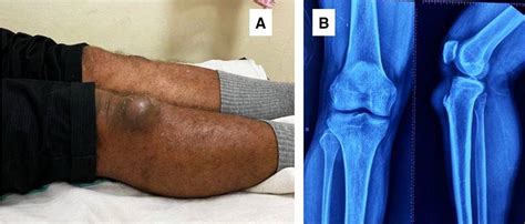 Case Of Infrapatellar Bursitis In 58 Year Old Clergyman
