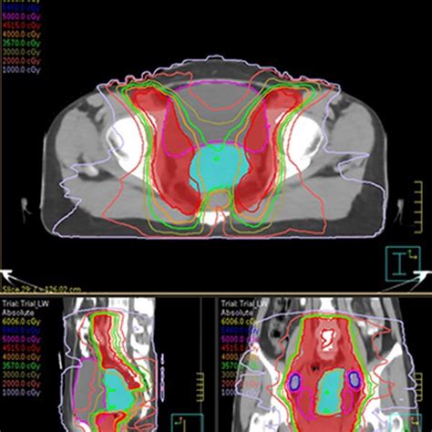 An Example Of Dose Distributions For The Modified Volumetric‐modulated