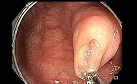 Endoscopy Remay Specialist Services