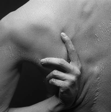 Revolutionizing Atopic Dermatitis