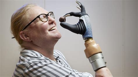 Woman S Experimental Bionic Hand Passes Major Test With Flying Colors