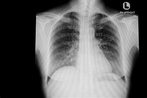 Pecho Normal X Ray Del Ser Humano Imagen De Archivo Imagen De Pecho