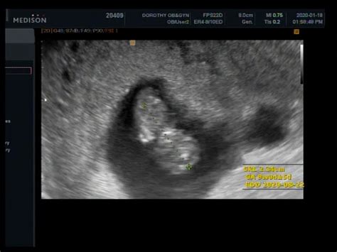 임신일기 9주차 입덧이 갑자기 심해지다 젤리곰 초음파 네이버 블로그