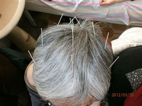 Scalp Acupuncture Acupuncture And Chinese Medicine
