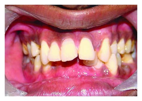 Oromandibular Limb Hypogenesis Syndrome Type Iib Case Report Of