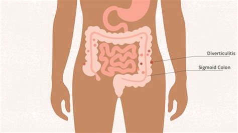 How Diverticulitis Develops In The Sigmoid Colon