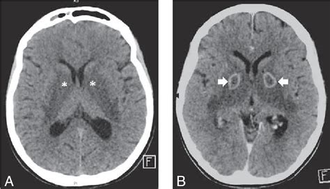 Globus Pallidus Relationship Of Activity In The Subthalamic