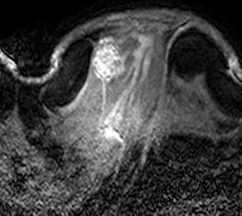 Intraductal Papilloma Features On Mr Ductography Using A Microscopic Coil Ajr