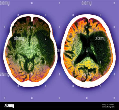Stroke Coloured Computed Tomography Ct Scans Of Axial Sections Through The Head Of A 62 Year