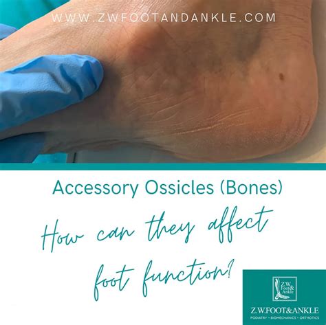 Ossicles Foot Sesamoids And Accessory Ossicles Of The Foot Anatomical