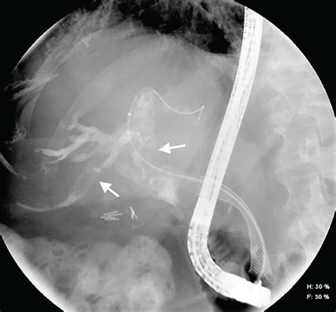 What Is Ercp Stent Placement At Joy Herman Blog