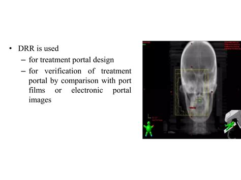 Three Dimensional Conformal Radiation Therapy Pptx 3 D Graphics Computer Software And