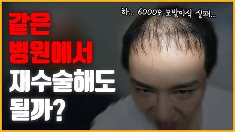 수술 실패 했는데 재수술 같은 병원에서 싸게 해준대요모발이식 재수술 병원 고를 때 유의해야 할 점 Youtube