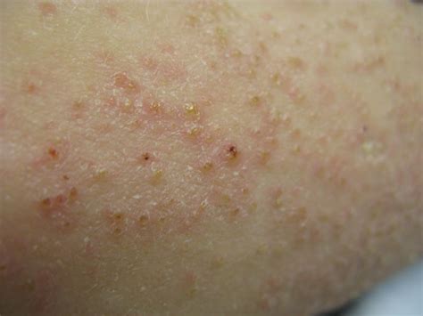 Dry Rash On Skin My XXX Hot Girl