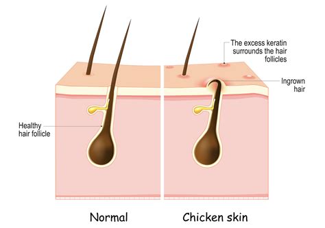 Milia Sebaceous And Hyperplasia Top Trend Beauty Clinic