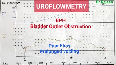 Uroflowmetry Urology Clinic In Selangor Malaysia
