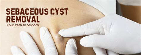 Sebaceous Cyst Removal