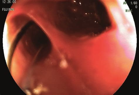 Enlargement In Hepaticojejunostomy Anastomosis Stricture After Balloon Download Scientific