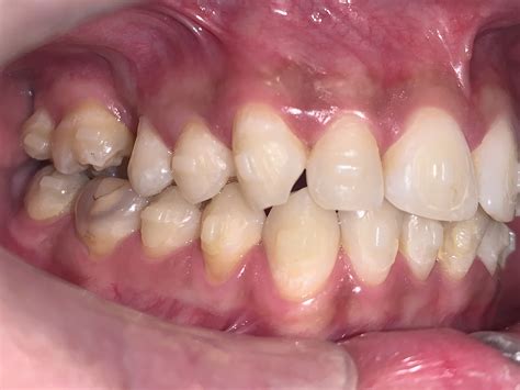 Case Gallery ClearCorrect