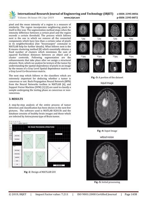 Irjet Mri Image Processing Operations For Brain Tumor Detection Pdf