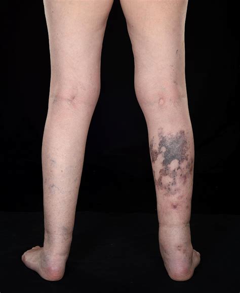 Diphencyprone Dpcp Skin Cancer Surgery Website