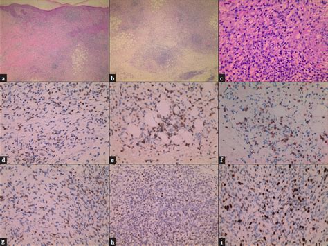 Chronic Active Epstein Barr Virus Infection Mimicking Dermatomyositis