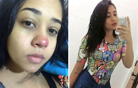 Mrsa Infection In Nose