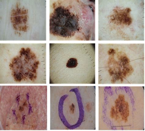 Skin Lesion Images From The Isic Dataset Download Scientific Diagram