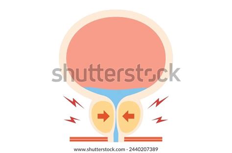 Medical Illustration Benign Prostatic Hyperplasia Enlarged Stock Vector