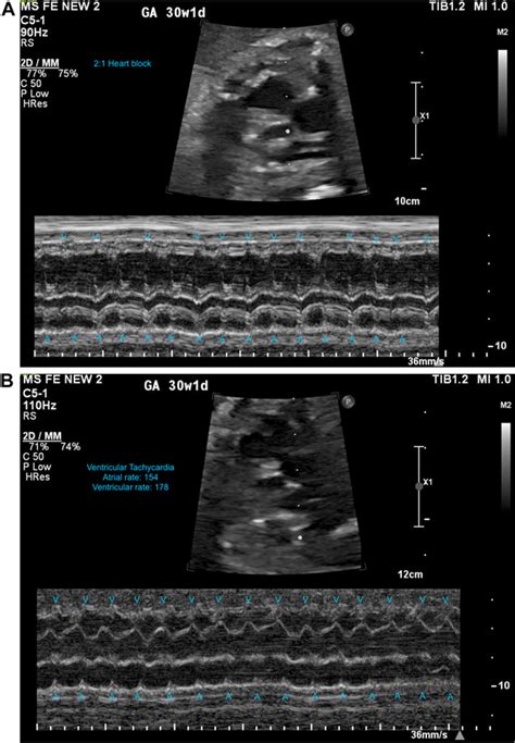 Fetal Arrhythmia Leading To A Diagnosis Of Congenital Long Qt Syndrome Type Ii Jacc Case Reports