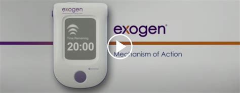 How Exogen Works Exogen Ultrasound Bone Healing System