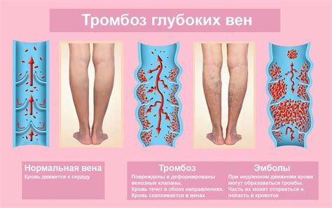 Тромбоз вен: причины и симптомы, лечение и диагностика, осложнения ...