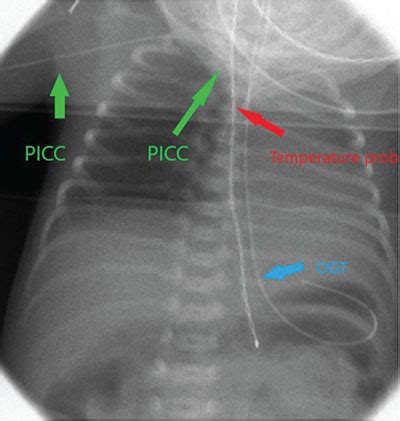 Picc Line X Ray Neonate