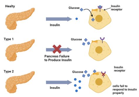 Diabetes Type 2 Insulin