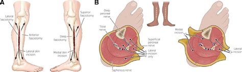 Lower Leg Fasciotomy A Description Of Both Lateral And Medial