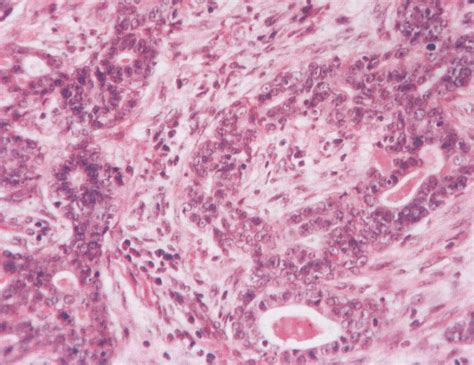 常见口腔黏膜癌及癌前病变的组织学表现 口腔颌面肿瘤学