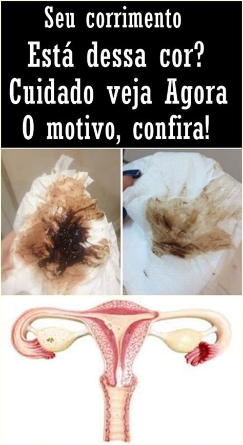 Corrimento Marrom Escuro Antes Da Menstruacao Menstruação Escura 6