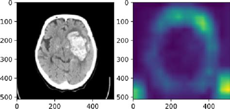 classification of hematoma joint learning of semantic segmentation and