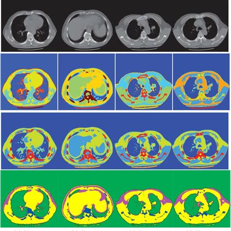 Segmentation Results From Slices From Four Patients The First Row