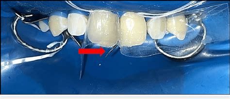 Mylar Strip And Sectional Matrix Used For Closing The Diastema Between Download Scientific Mylar Strip And Sectional Matrix Used For Closing The Diastema Between Download Scientific