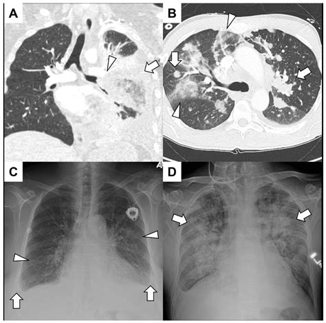 Cancers Free Full Text Hemoptysis In Cancer Patients