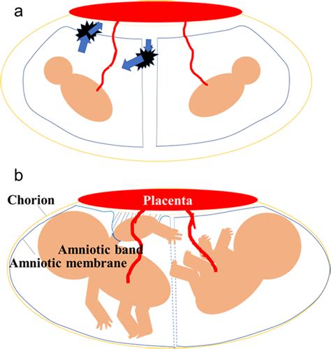 Predicted Pathology Of Amniotic Band Syndrome Following Rupture Of The
